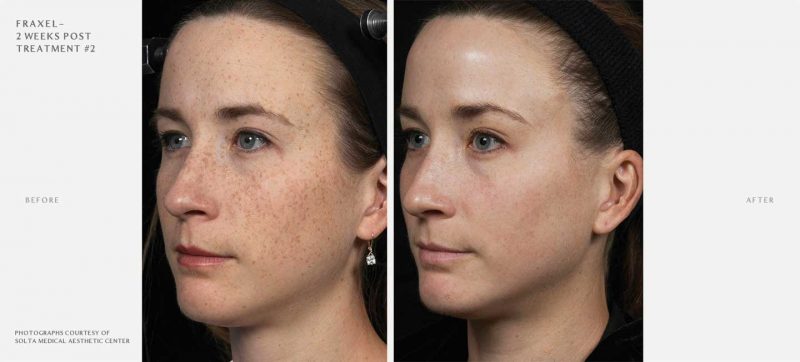 Fraxel Laser Treatment - Los Feliz Med Spa