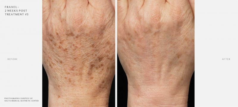 Fraxel Laser Treatment - Los Feliz Med Spa