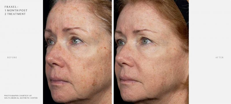 Fraxel Laser Treatment - Los Feliz Med Spa