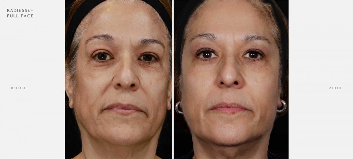 Radiesse Injections - Los Feliz Med Spa