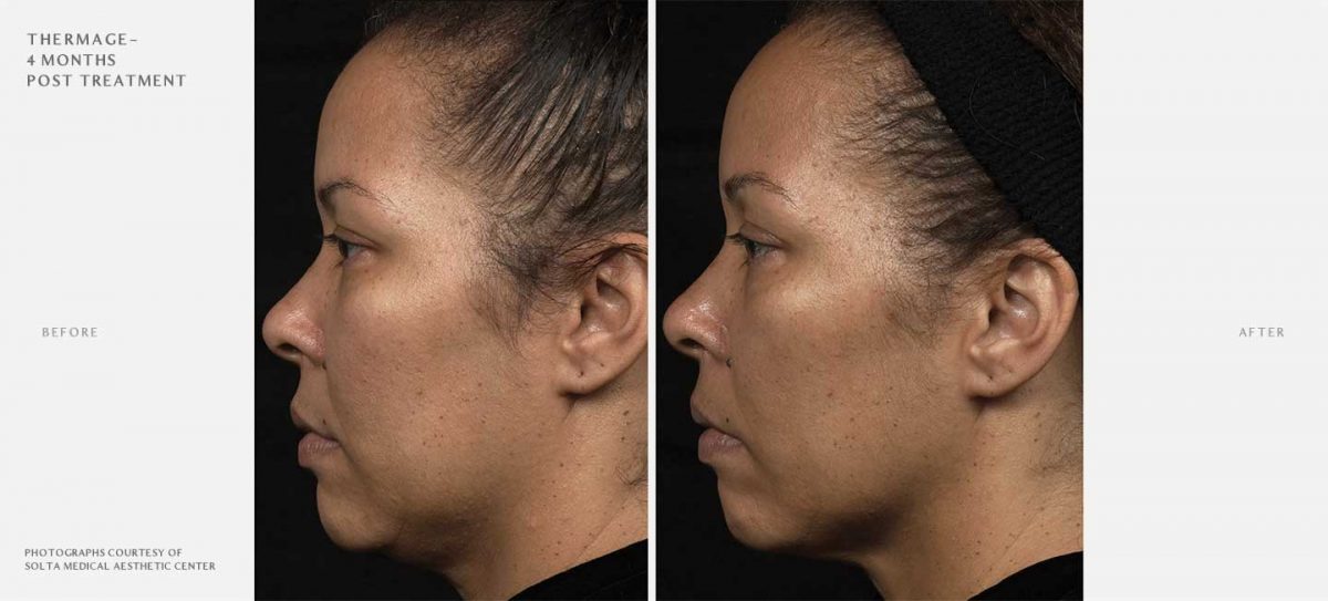 Thermage Skin Tightening - Los Feliz Med Spa